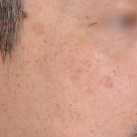 Deka-Again PRO - ASCLEPION